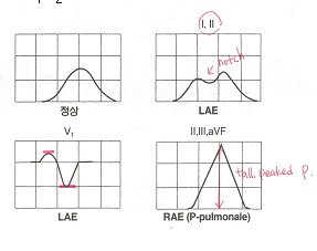 그게 P-mitrale야?, P-pulmonale지. : 네이버 블로그