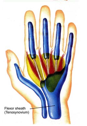 협착성건초염 (Stenosing Tenosynovitis) : 네이버 블로그
