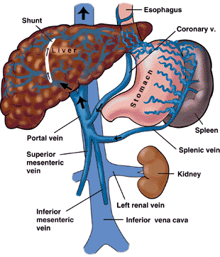 TIPS(transjugular intrahepatic portosystemic shunt) : 네이버 블로그