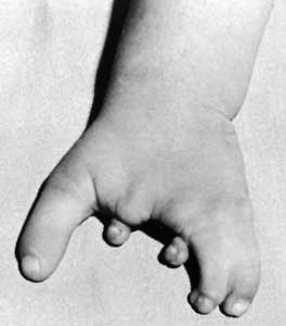 [희귀병] 열지증 Split Hand-Split Foot : 네이버 블로그