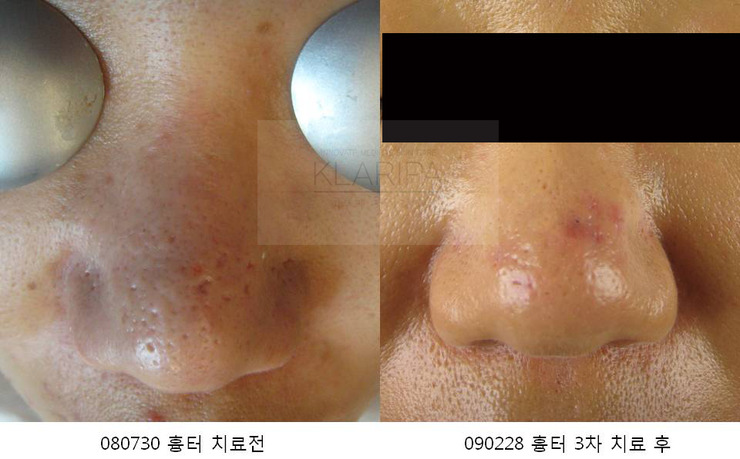 코 모공 흉터 치료 전후 사진 수술 롱펄스 어븀 레이저박피 클라리파 피부과 네이버 블로그