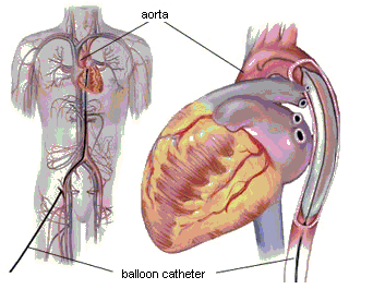IABP 시술장면-외과의사 봉달희 중에서 : 네이버 블로그