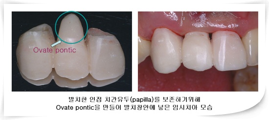 앞니를 뽑고 걱정되셔요? (ovate pontic) : 네이버 블로그