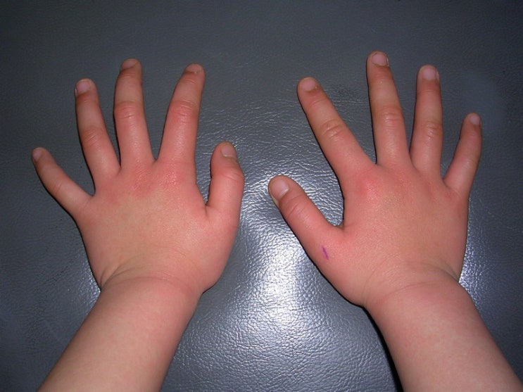 소아 PPGSS(Papular Purpuric Golves and Socks Syndrome) 피부질환 : 네이버 블로그